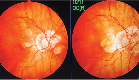 Diagnosing And Treating Optic Nerve Head Drusen