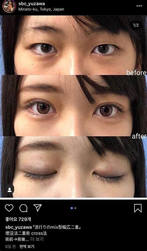 신기하다는 반응이 많은 일본 쌍수 후기 인스티즈instiz 이슈 카테고리