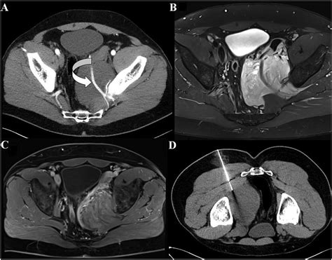 Long Term Experience With Percutaneous Biopsies Of Pelvic Lesions Using