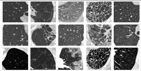 Figure 3 from Interstitial lung disease detection using template matching combined sparse coding ...