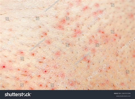 Ingrown Hairs Genital