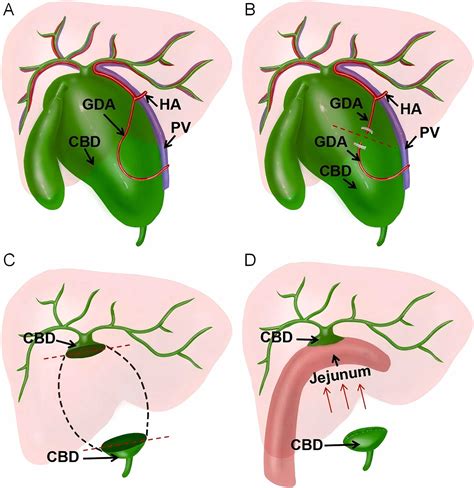 Multimodal Navigation Technology For Giant Choledochal Cyst Resection