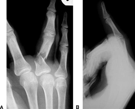 Metacarpal Osteotomy For Correction Of Acquired Phalangeal Rotational