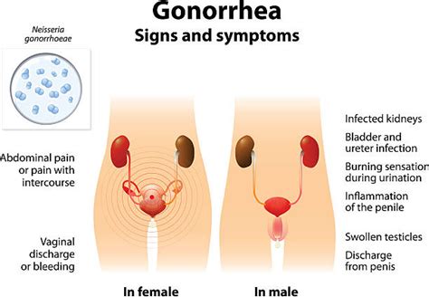 Gonorrhea Clipart 10 Free Cliparts Download Images On Clipground 2026
