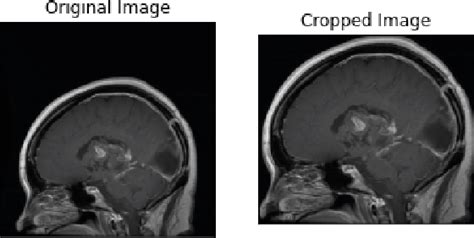 Figure 1 From Brain Tumor Detection System Using Convolutional Neural Network Semantic Scholar