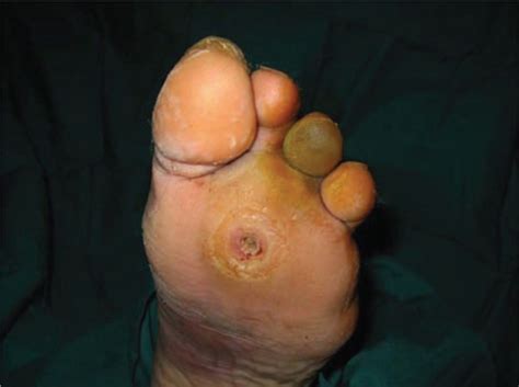 Neuropathic Plantar Ulceration With Necrosis Of The Third Toe