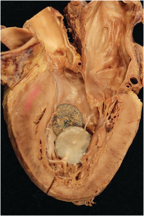 Ventricular Septal Defect Gross