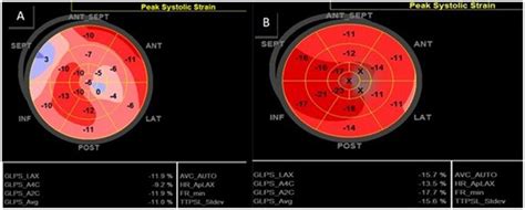 Two Dimensional Speckle Tracking Imaging Of Left Ventricular Download Scientific Diagram
