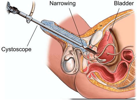 Urethrotomy Healthdirect