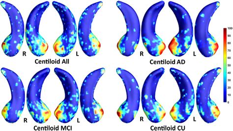 Federated Morphometry Feature Selection For Hippocampal Morphometry