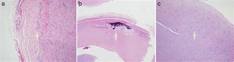 Pathology Of The Excised Aneurysmal Tissue Revealed The Proliferation