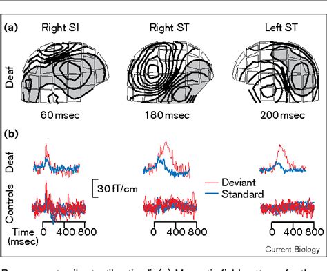 Figure 1 From Vibration Induced Auditory Cortex Activation In A Congenitally Deaf Adult