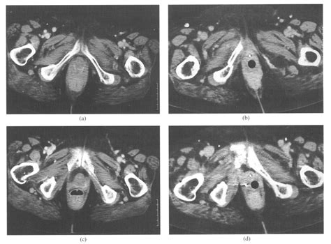 Ct Scans Of The Pelvis Showing The Development Of Pubic Ramus Fractures