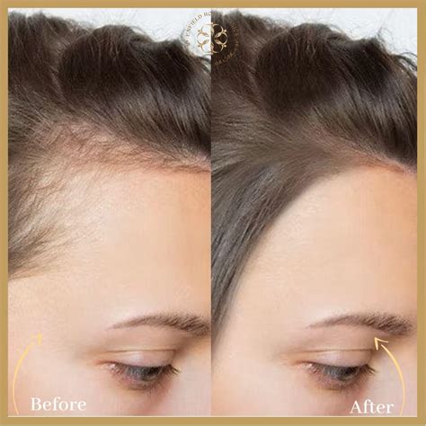 Female Hair Loss Treatment In Islamabad Pakistan Ercs
