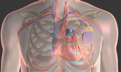Synchronized Left Ventricular Pacing As Effective As Conventional Crt