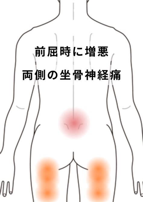前屈時に増悪する両側の坐骨神経痛｜坐骨神経痛、腰痛のツボ｜ツボネット 鍼灸の症例が検索できるツボ辞典