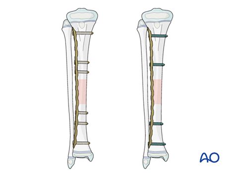 Open Reduction Plate Fixation For Multifragmentary Tibial Fracture