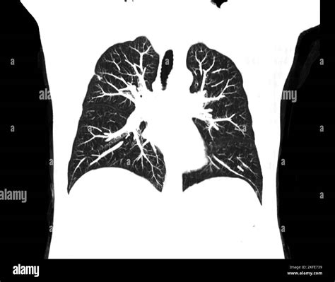CT Scan Of Chest Or Lung Coronal View At Radiology Department In Hospital Covid Scan Body