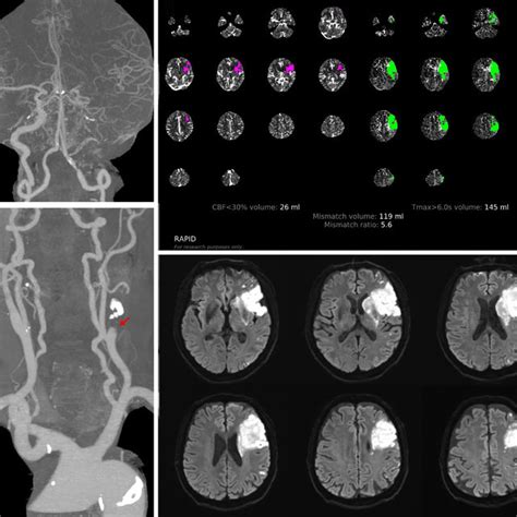 Brain Perfusion Computed Tomography Angiography Cta And Magnetic Download Scientific Diagram