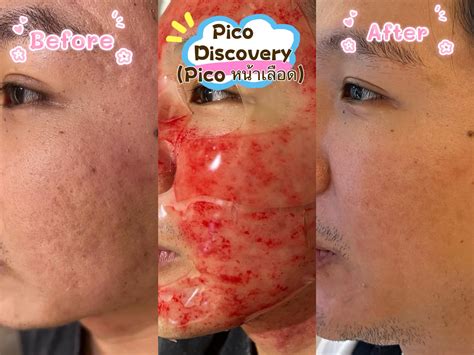 Lushwood รีวิวจริง หลุมสิวตื้นขึ้น รูขุมขนกระชับ รอยดำจางลง ด้วย Discovery Pico Laser 📸 Bef๐