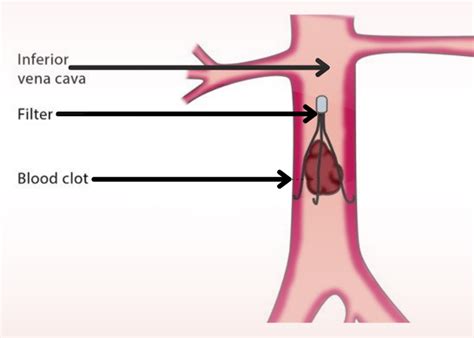 Safe Minimally Invasive Dvt Treatment In Aurangabad