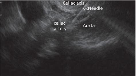How To Do Celiac Plexus Block Radiology Key