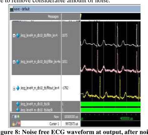 Figure 1 From Analysis Of Ecg With Db 10 Wavelet Using Verilog Hdl Semantic Scholar