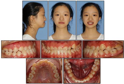Mandibular Hypoplasia Treatment