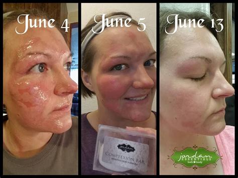 2nd Degree Burn Healing Stages Vanessa Bower