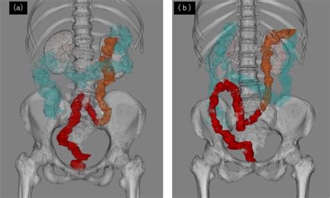 Mesh Fixation To The Sacral Promontory From The Left Side Of The