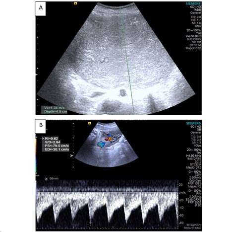 Pregnancy With Diabetes And Macrosomia Gestational Age 35 Weeks And Download Scientific