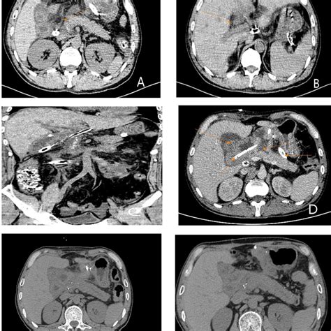 Ct Scan Whole Abdomen Godawari Ct Scan