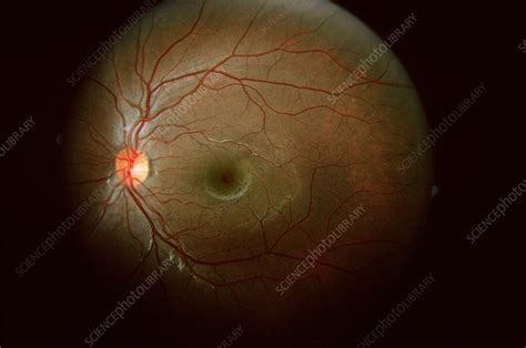 Retinal Coloboma Stock Image C0031366 Science Photo Library