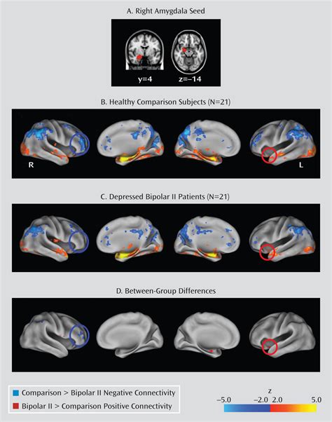 Regional Fmri Hypoactivation And Altered Functional Connectivity During Emotion Processing In