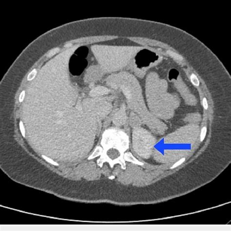 Abdominal Computed Tomography Ct Scan Download Scientific Diagram