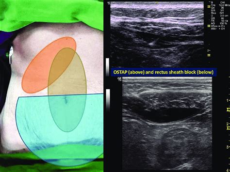 Giant Rectus Sheath Hematoma The Ultrasound Journal