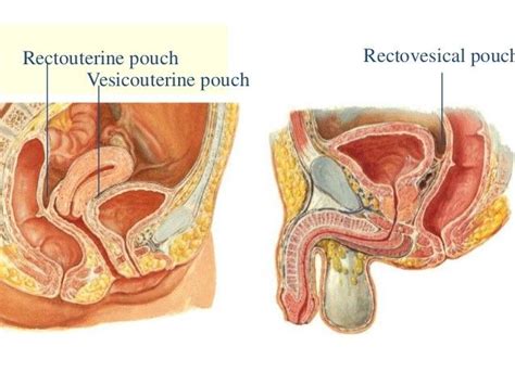 Rectouterine Pouch