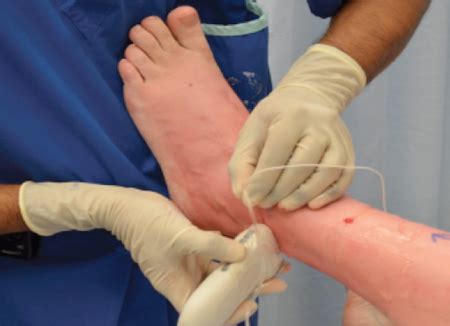 USRA Ankle Block
