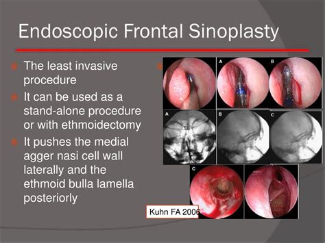Ppt Frontal Sinus Surgery Powerpoint Presentation Free Download Id 2192513