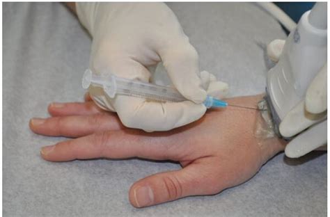 Second Dorsal Compartment Of Wrist Injection Wikism Sports Medicine Wiki