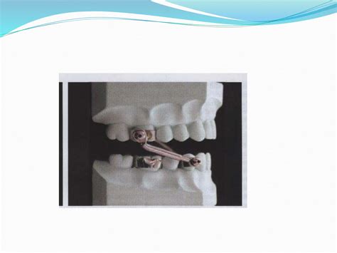 Fixed Functional Appliances In Orthodontics Pptx