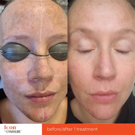 Non Ablative Laser Skin Resurfacing Aesthetics Institute