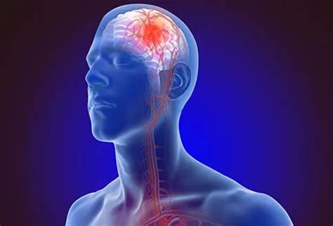 What Is The Difference Between Ischemic Stroke And Hemorrhagic Stroke