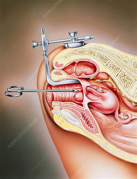 Illustration Of Female Sterilization Stock Image M8600070