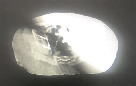 Cbct Artifacts R Medicalphysics