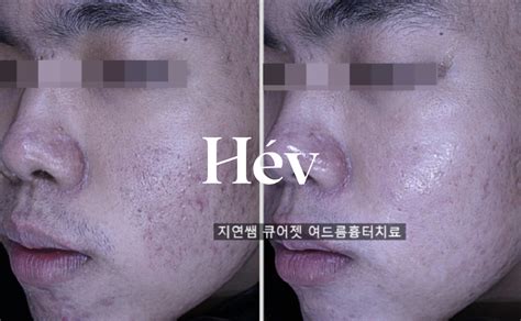 큐어젯 쥬베룩 키닥터 열상 봉합 파인 여드름 흉터 치료 효과와 시술 전후 헤브피부과