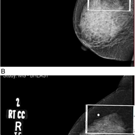 Us Right Breast And Axilla Showing 15 × 12 × 13 Mm Hypoechoic Solid Download Scientific Diagram