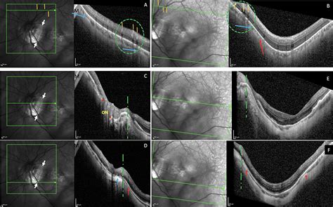 Understanding Posterior Staphyloma In Pathologic Myopia Opth