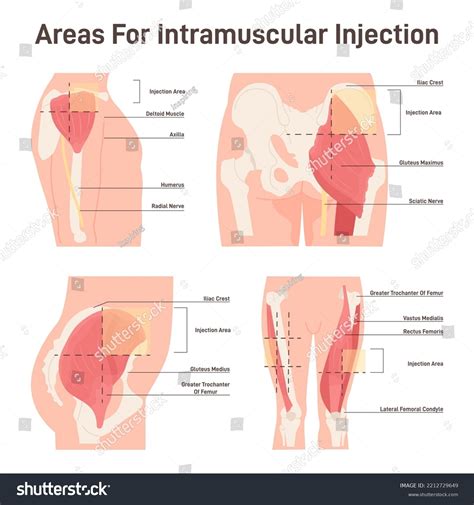 Injection Areas Over 845 Royalty Free Licensable Stock Illustrations
