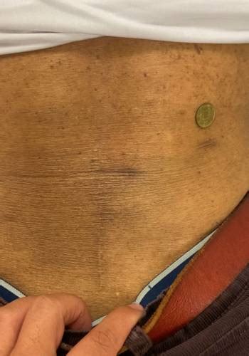 Endoscopic Spine Surgery In Singapore Achieve Spine